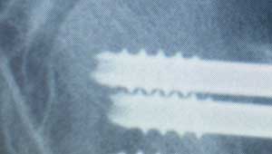 Ossio launches bone regeneration sutures in US | OurCrowd